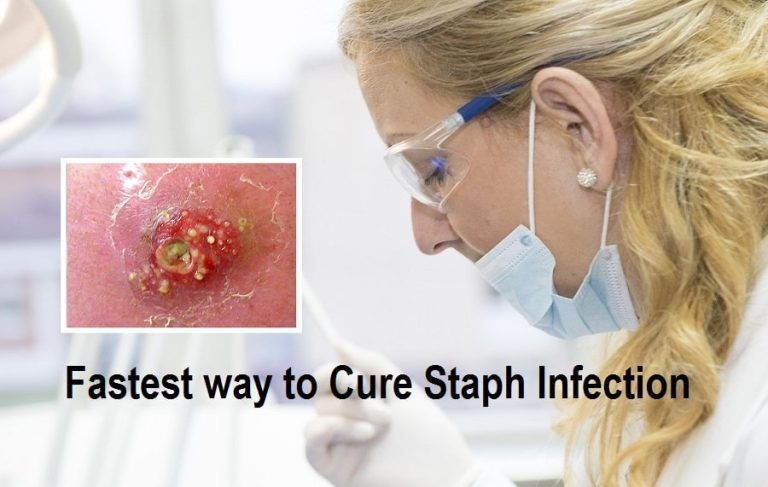 3 Fastest way to Cure Staph Infection